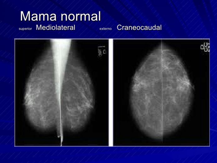 Día mundial contra el cáncer de mama: 19 de octubre