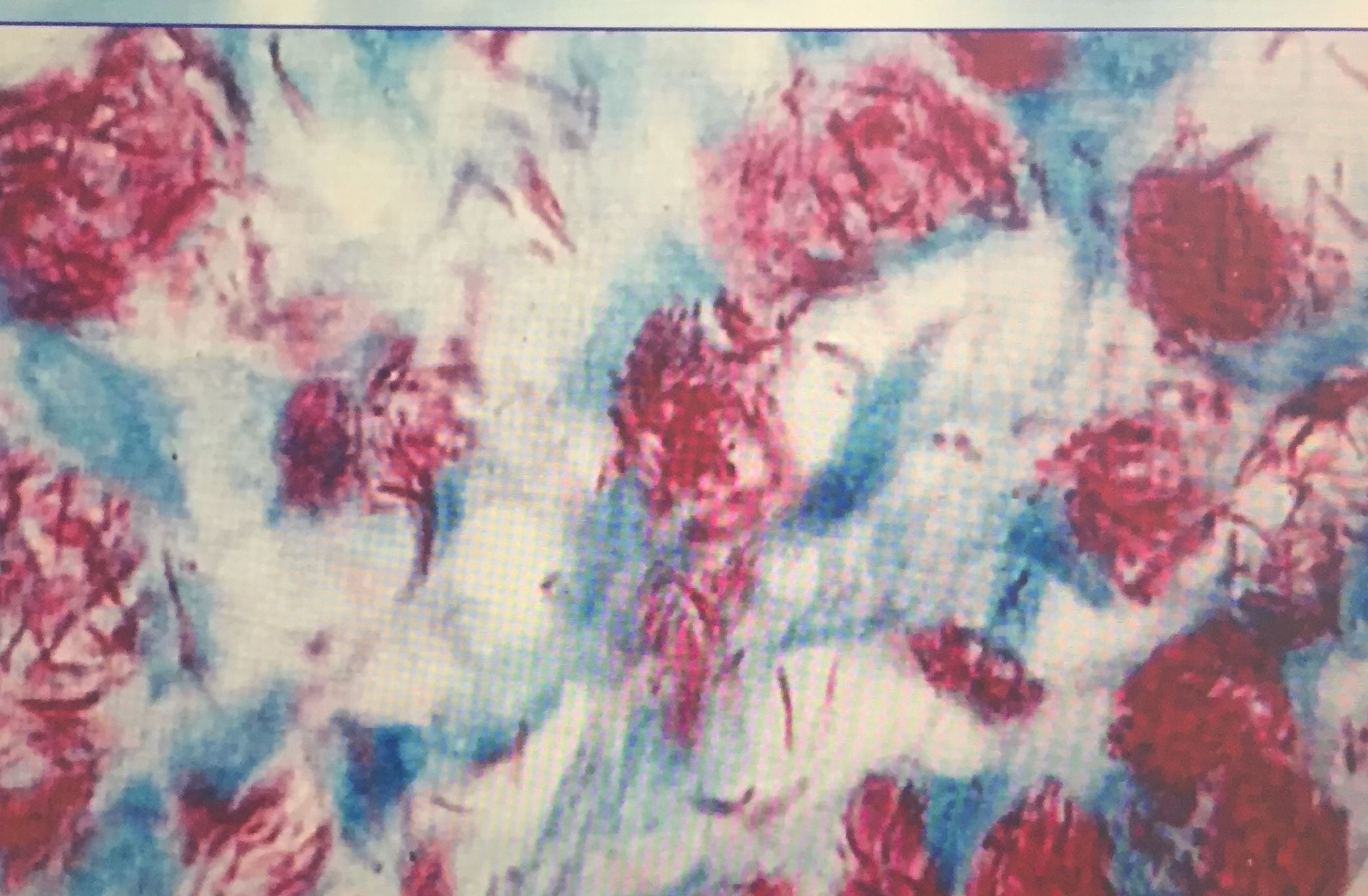Alice Ball: química contra la Lepra.